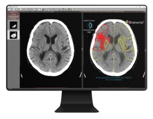 Harnessing AI technology to speed up access to specialist stroke care ...